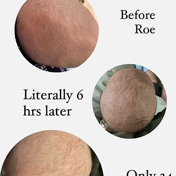 Before And Afters – roe Wellness