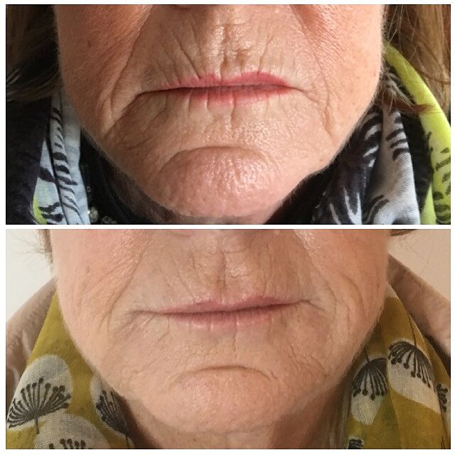 AngelLift® DermaLips