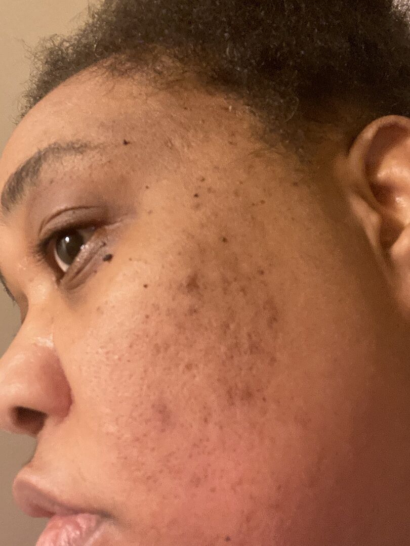 Best Vitamin C (15%) Serum To Fade Dark Marks | Hyper Skin