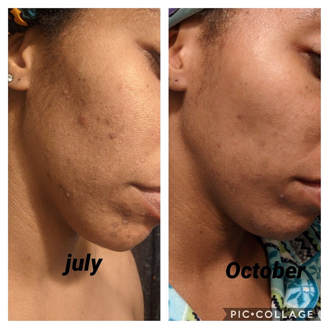 Collections – Hyper Skin